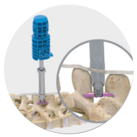 Vertiflex | Advanced Surgery Center