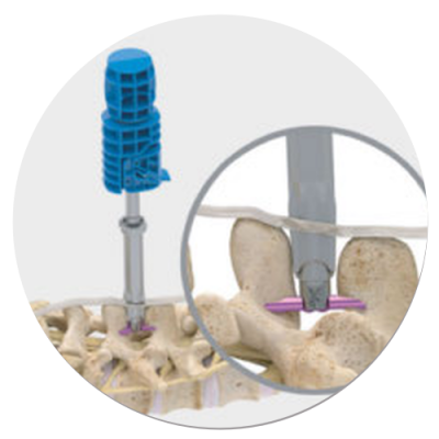 Vertiflex | Advanced Surgery Center