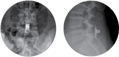 Vertiflex | Advanced Surgery Center