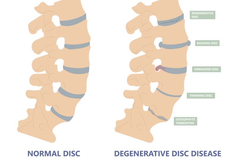 Degenerative Disc Disease Causes, Symptoms & Treatments | Advanced ...